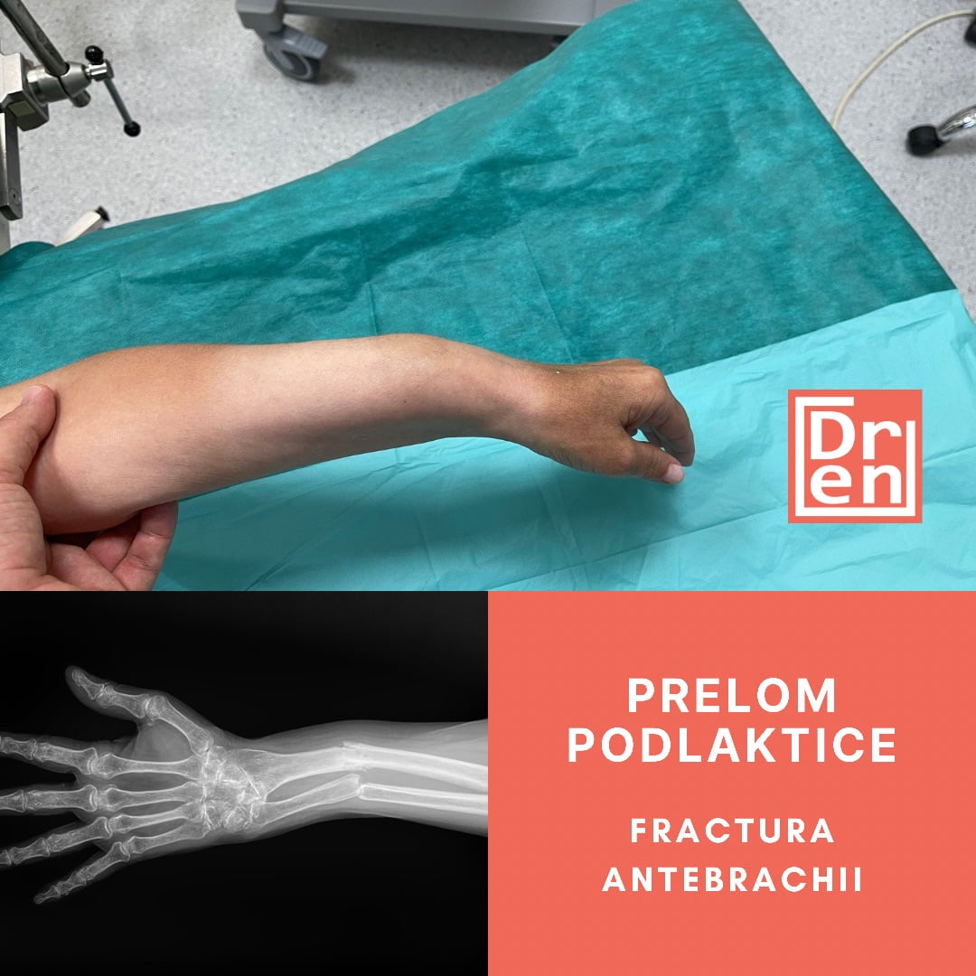prelom podlaktice fractura antebrachii fraktura ruke radiusa i ulne ...