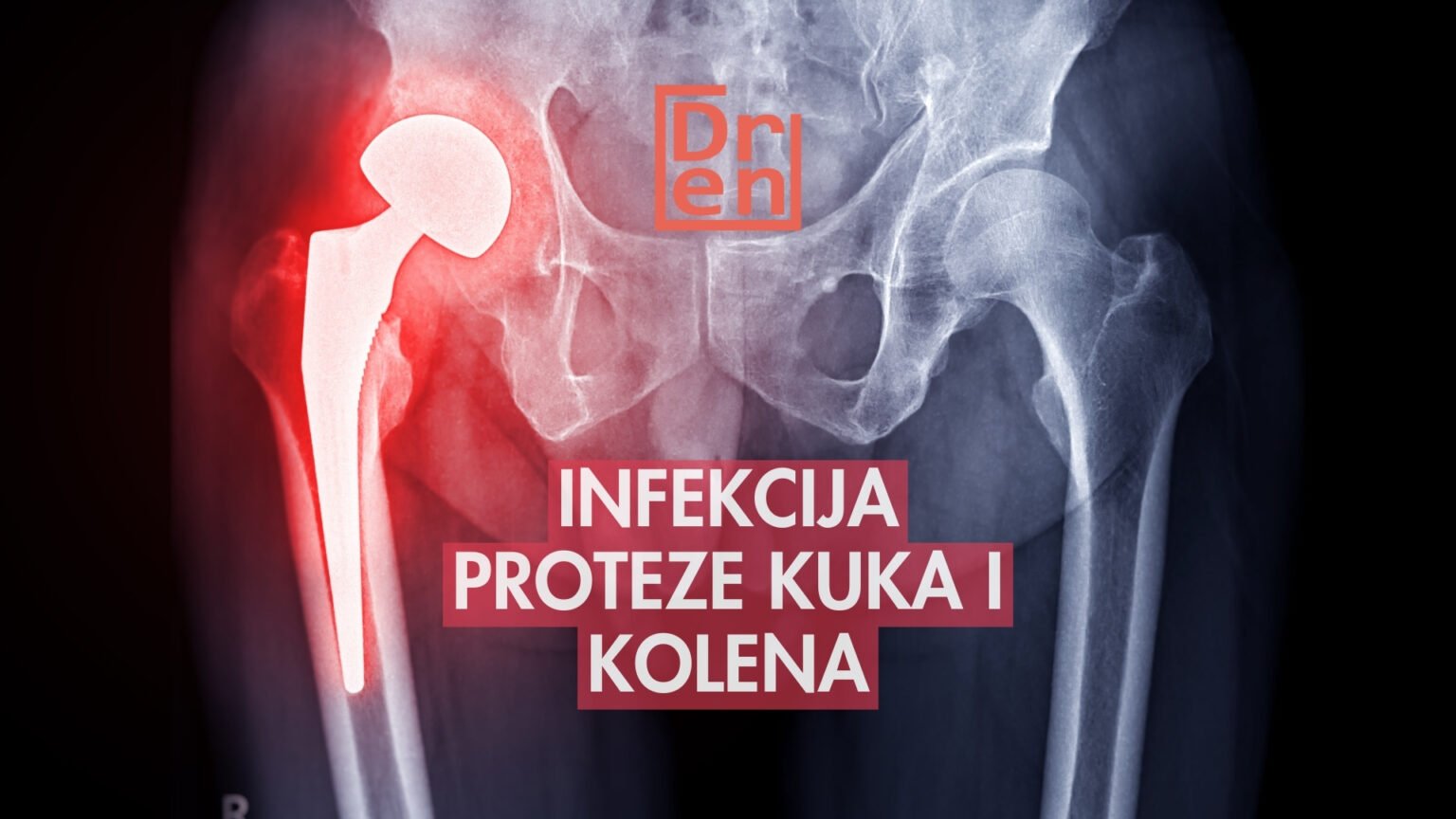 Infekcija proteze veštačkog kuka i kolena - Dr Dren