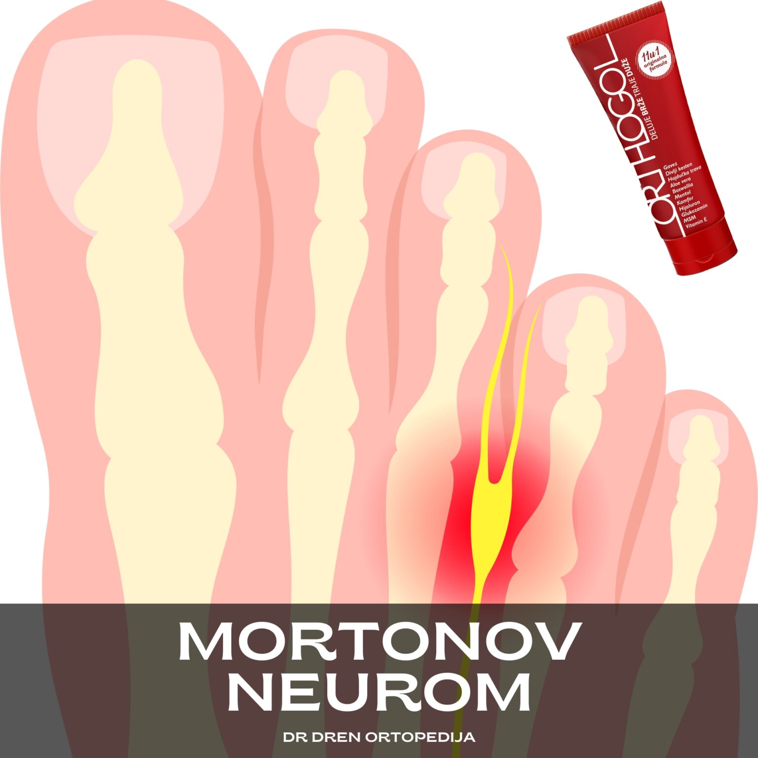 Mortonov neurom - kako prepoznati i rešiti se bola - Dr Dren