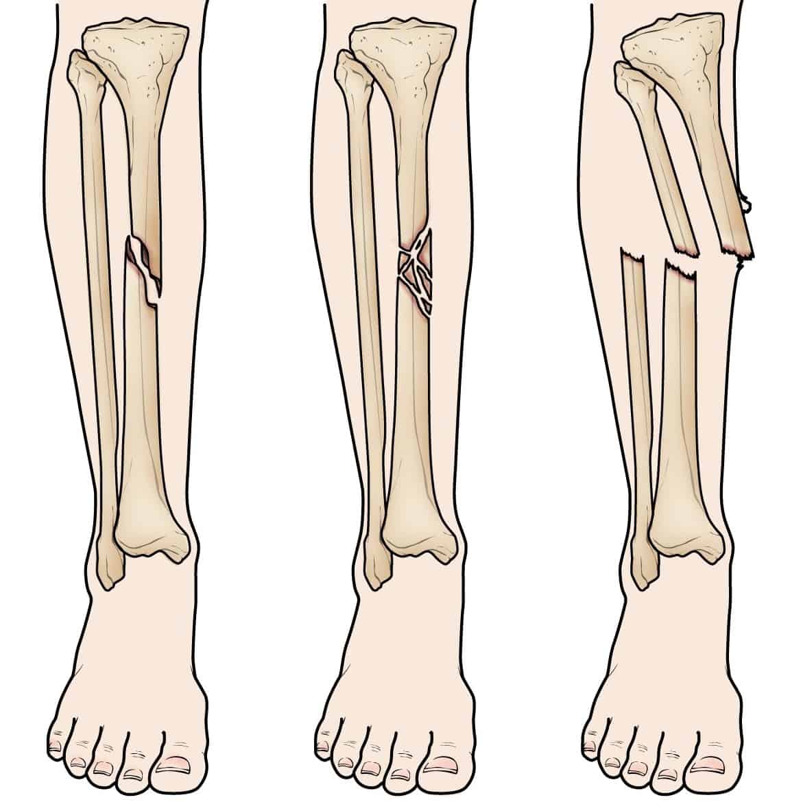 Prelom potkolenice – Fractura cruris - Dr Dren
