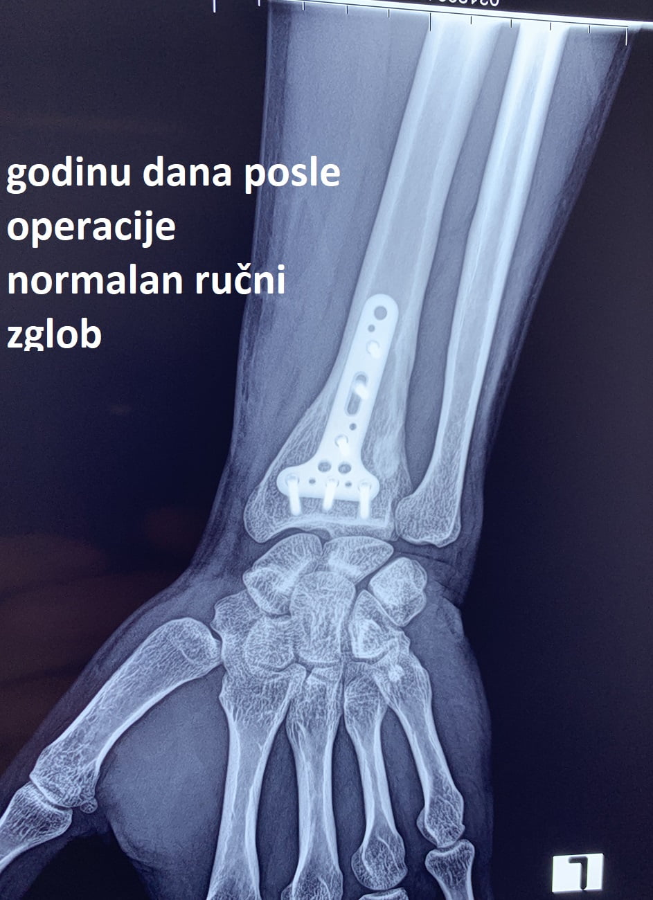 Prelom ručnog zgloba - od povrede do oporavka - Dr Dren