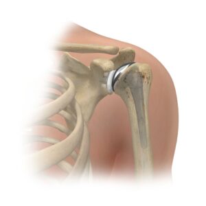 Proteza ramena – artroplastika ramena veštačko rame - Dr Dren