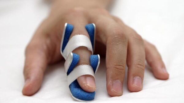 Prelom prsta šake Prelomi prstiju ruke - Dr Dren