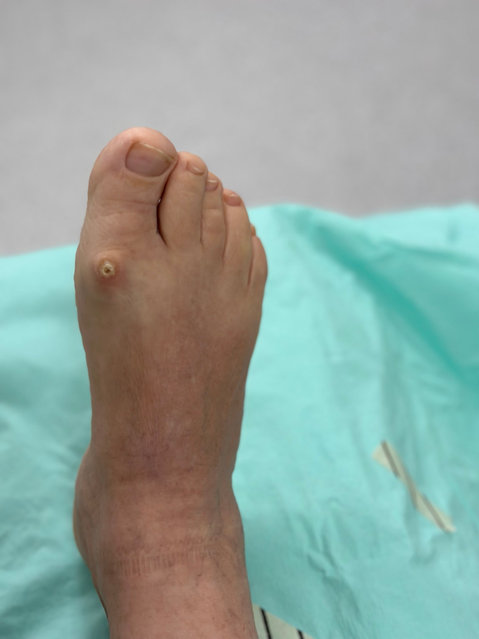 hallux rigidus tzv. čukalj i kurje oko pre operacije - Dr Dren