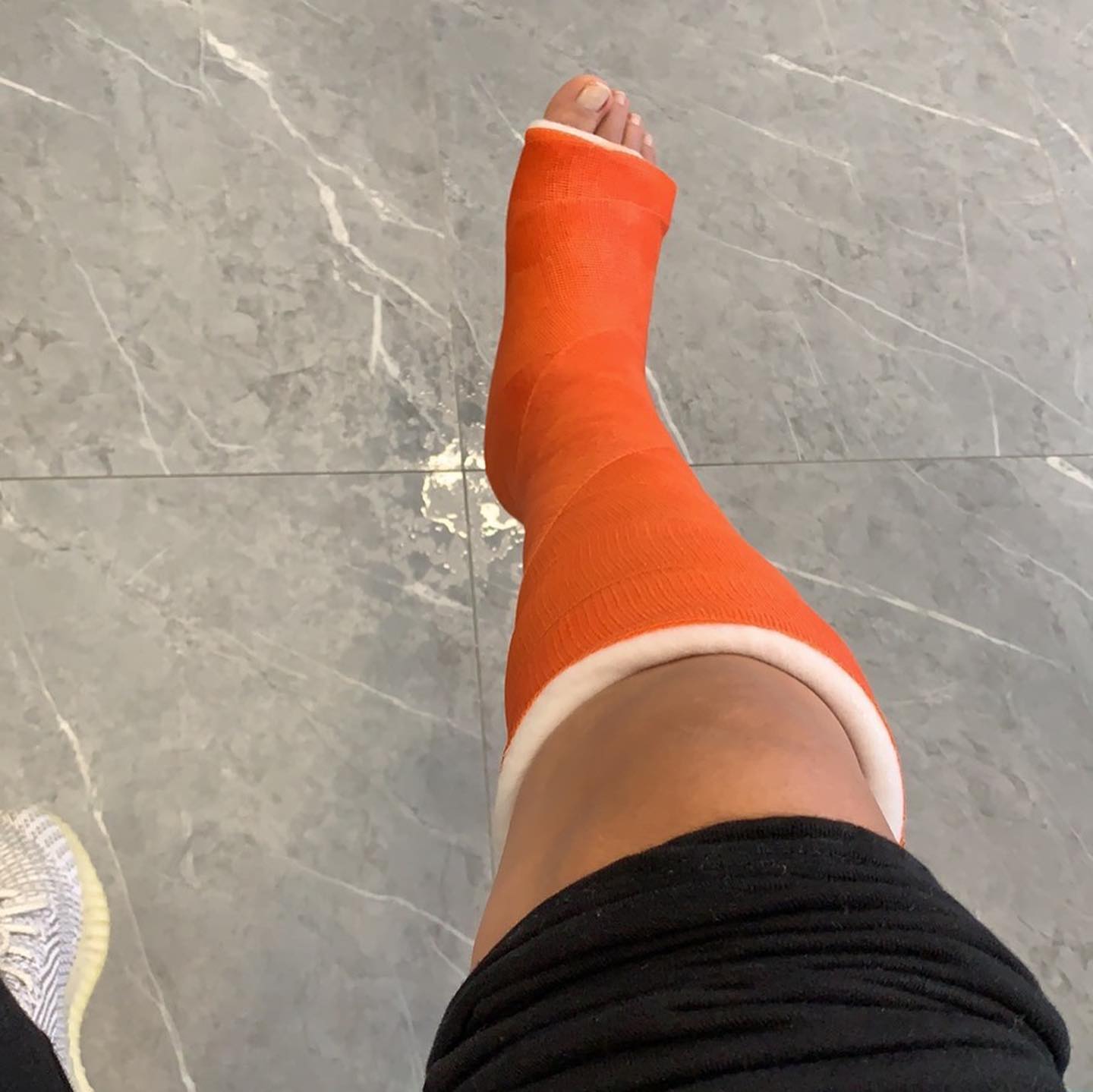 plastični gips imonbilizacija preloma noge ili ruke umesto običnog ...