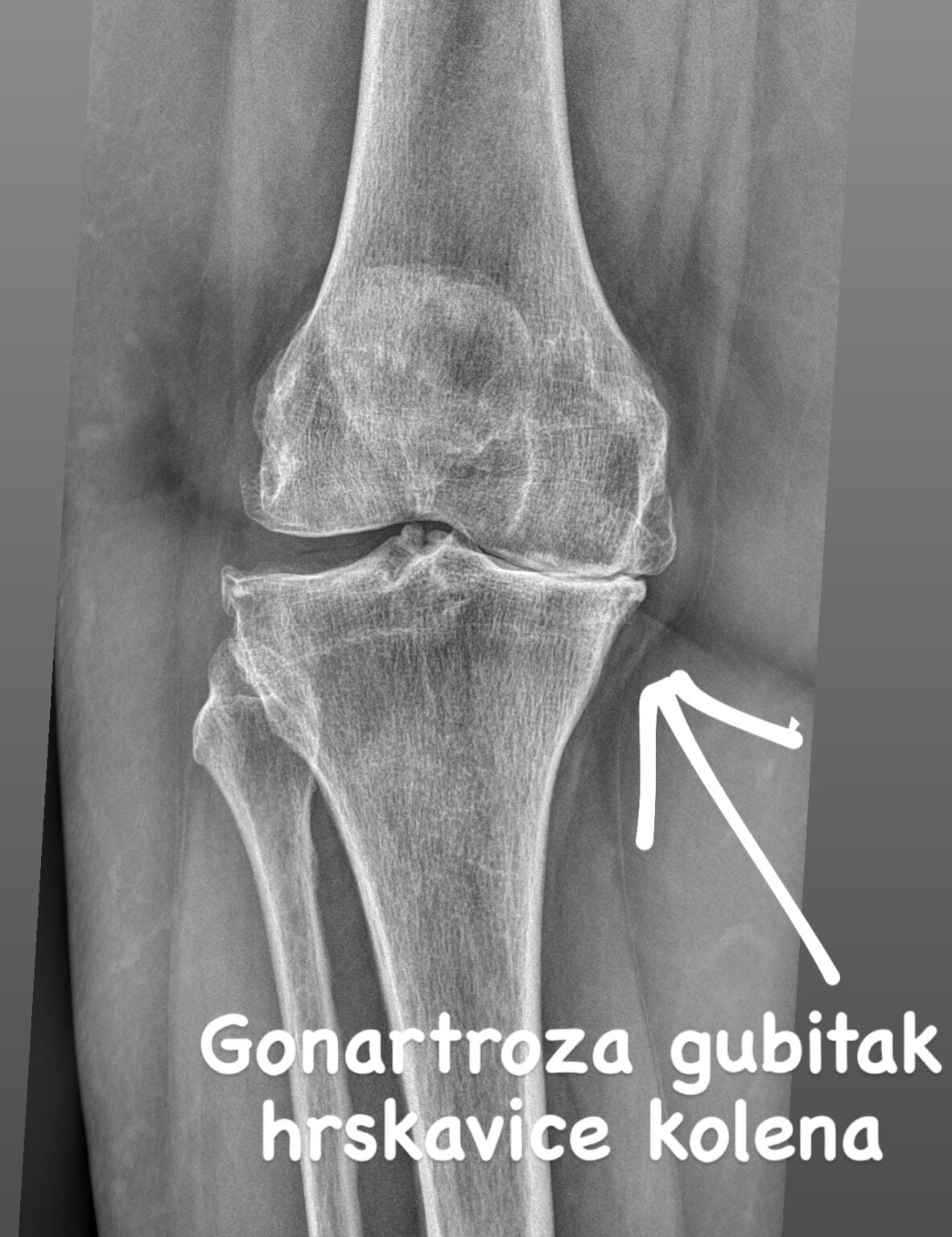 Artroza kolena – Gonartroza kolena - Dr Dren