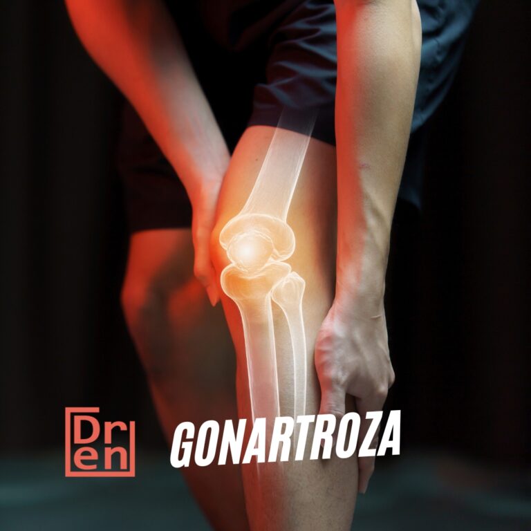Artroza kolena – Gonartroza kolena - Dr Dren