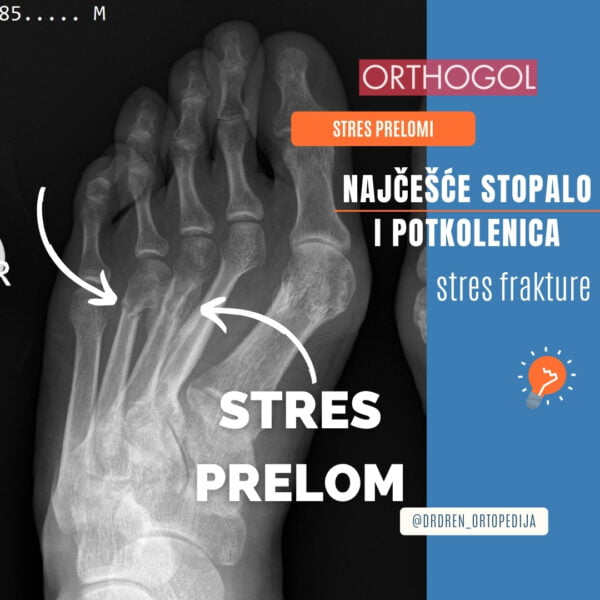 Stres prelom – stres faktura kosti - Dr Dren