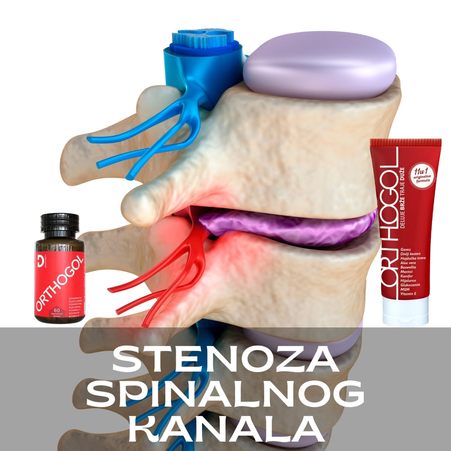 stenoza spinalnog kanala, spinalna stenoza, operacija stenoze spinalnog ...